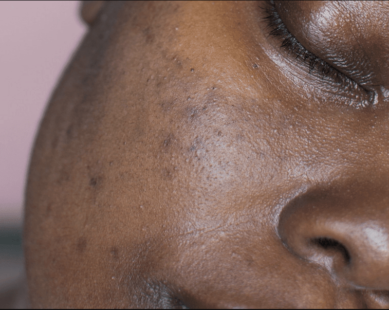 Le mélasma : comprendre, traiter et prévenir l’hyperpigmentation sur p ...
